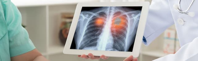 Lung Cancer Diagnosis Test: Essential Screenings